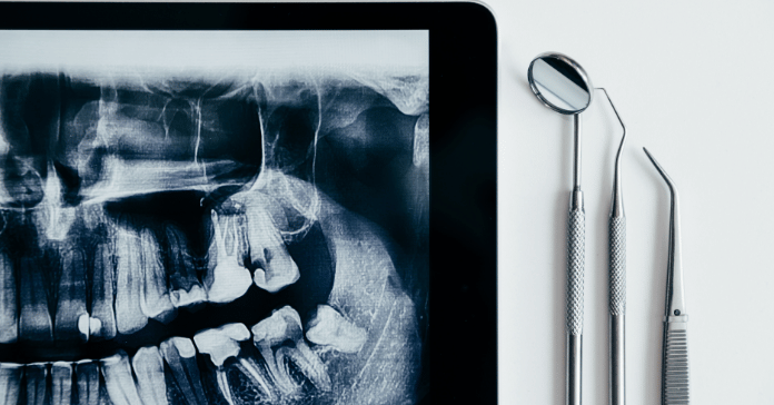 Tooth Extraction Complications: Risks After Dental Extractions - Share ...