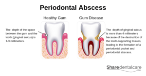 Gum Abscess: Symptoms, Causes, & Treatment - Share Dental Care