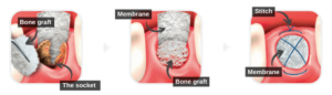 Bone Grafting for Dental Implants: Types, Risks, & Recovery - Share ...
