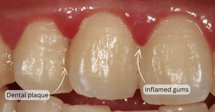 Gingivitis vs Healthy Gums: Spot Early Signs of Gum Disease - Share ...