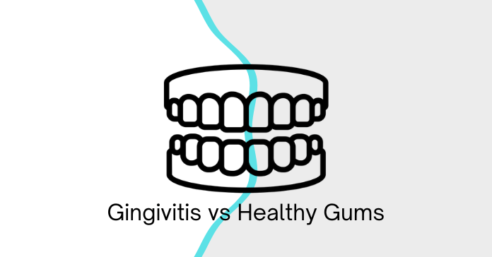 Gingivitis vs Healthy Gums: What Is the Difference? - Share Dental Care