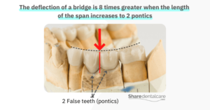 Dental Bridge Broke in Half: Causes & What to Do? - Share Dental Care