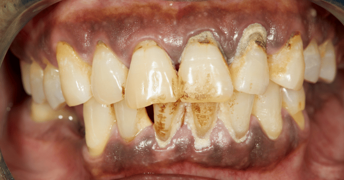 Does Smoking Cause Tooth Decay and Gum Disease? - Share Dental Care