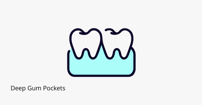 Deep Gum Pockets: Causes of Periodontal Pockets & Treatments - Share ...