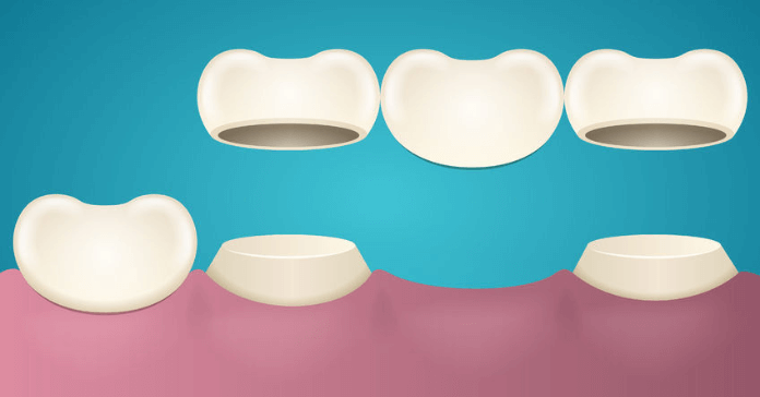 No Molars on One Side: Replacement Options for Missing Teeth - Share ...