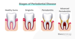 Periodontal Disease Jaw Bone Loss: Reverse Dental Bone Loss - Share ...