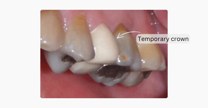 Temporary Crown Fell Off: Why and What To Do? - Share Dental Care