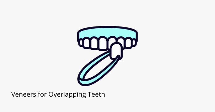 Veneers for Overlapping Teeth: Benefits & Procedure - Share Dental Care