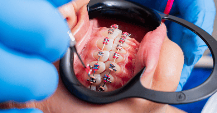 Lower Teeth Crowding Treatment: Orthodontic Treatment Explained - Share ...