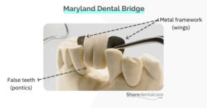 Dental Bridge for One Tooth: Types of Dental Bridges vs. Implants ...