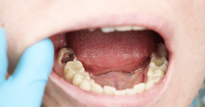 Tooth Nerve Pain: Home Remedies to Stop Toothache - Share Dental Care