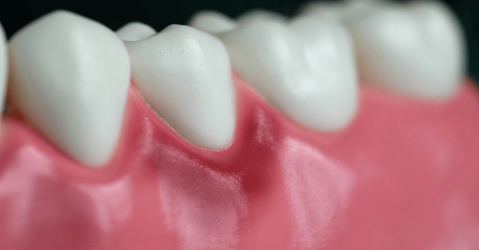 Symptoms of Gingivitis: Gum Disease Signs You Shouldn’t Ignore - Share ...