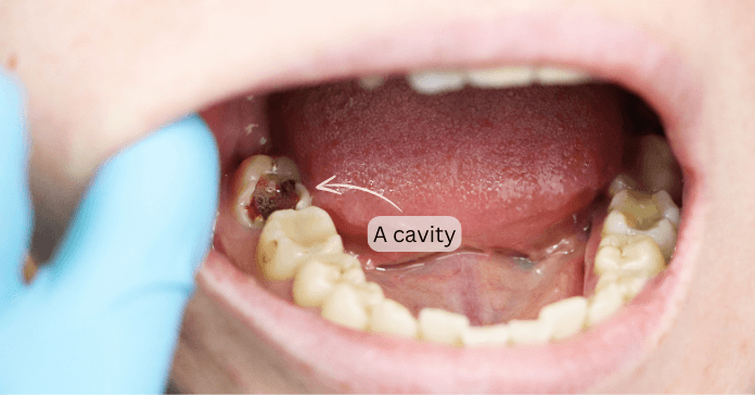 Hole in Tooth Pain Relief: Home Remedies for Cavity Pain - Share Dental ...