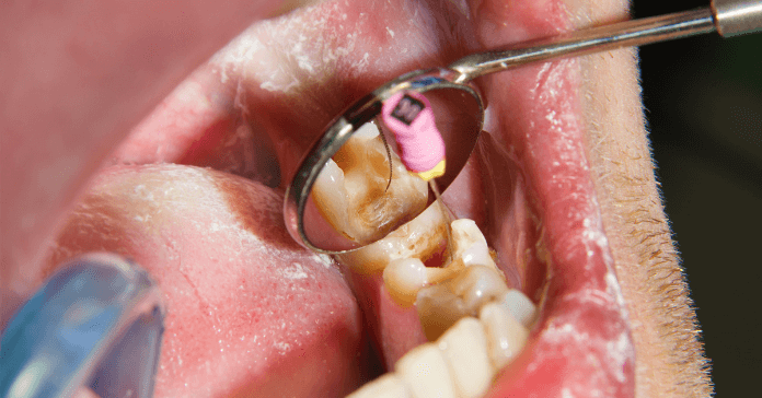 Hole in Tooth Pain Relief: Home Remedies for Cavity Pain - Share Dental ...