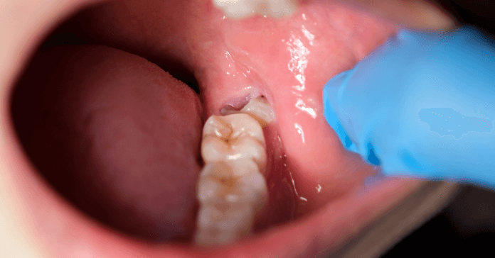 Gingival Operculum: Gum Flap Over Wisdom Tooth & Pericoronitis - Share ...