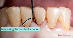 Periodontitis Stages - Share Dental Care