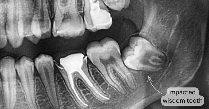 Pericoronitis Cure: Pain Relief at Home & Treatment Options - Share ...