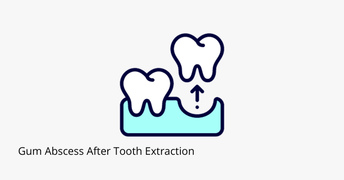 Gum Abscess After Tooth Extraction: Causes & Treatment - Share Dental Care