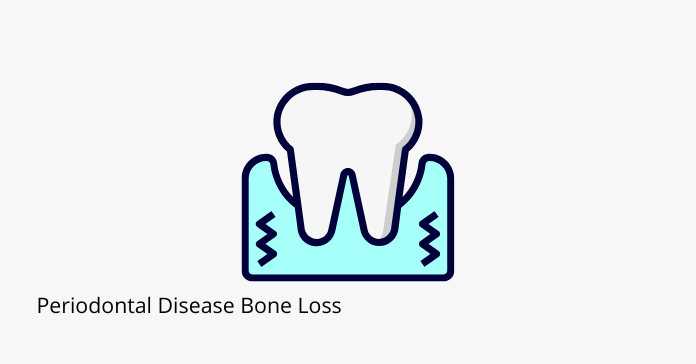 Periodontal Bone Loss: How to Treat Periodontitis & Rebuild Bone ...