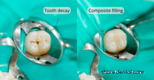 Composite Filling: Benefits, Drawbacks & Procedure - Share Dental Care