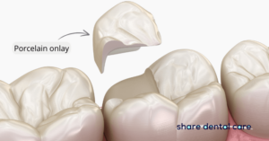 Porcelain Onlay: Benefits & What to Expect - Share Dental Care
