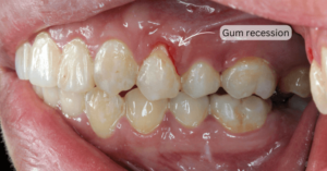 Gum Graft Failure: Signs, Causes, & What to Do - Share Dental Care