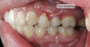 Gums Bleed When Flossing: Why & How to Stop the Bleeding - Share Dental ...
