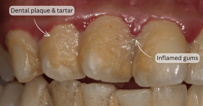 Tooth Decay Smell: Do Cavities Cause Bad Breath & Treatment - Share ...