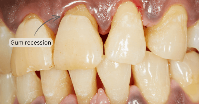 Gum Recession from Braces: How Orthodontics Affect Your Gums - Share ...