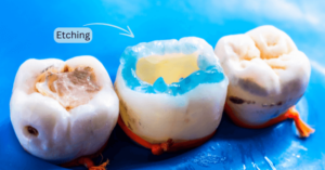 Tooth Colored Fillings: A Guide to Composite Dental Fillings - Share ...