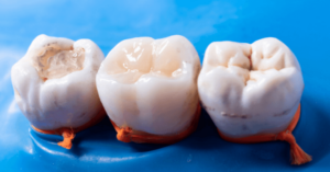Tooth Colored Fillings: A Guide to Composite Dental Fillings - Share ...