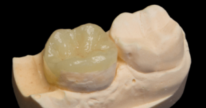 Dental Inlays vs Onlays — How to Know Which Is Right for You - Share ...