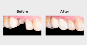 Porcelain Tooth Crown: Types, Pros, and Cons of Porcelain Crowns ...