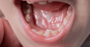 Tooth Growing Behind Baby Tooth: Causes of Shark Teeth in Kids - Share ...