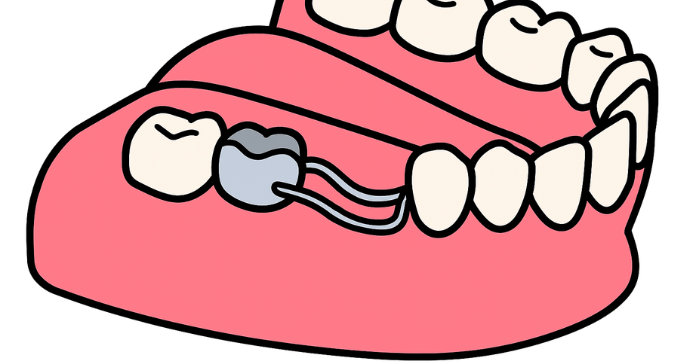 Space Maintainers: Why They're Essential in Pediatric Dentistry ...