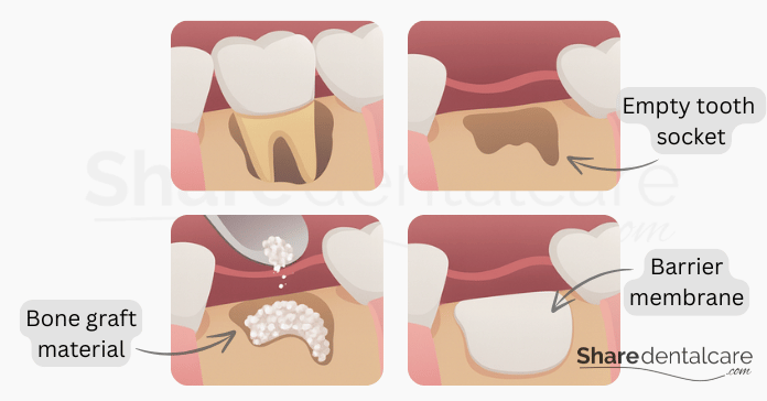 Bone Graft after Tooth Extraction: Why It’s Needed and Recovery - Share Dental Care