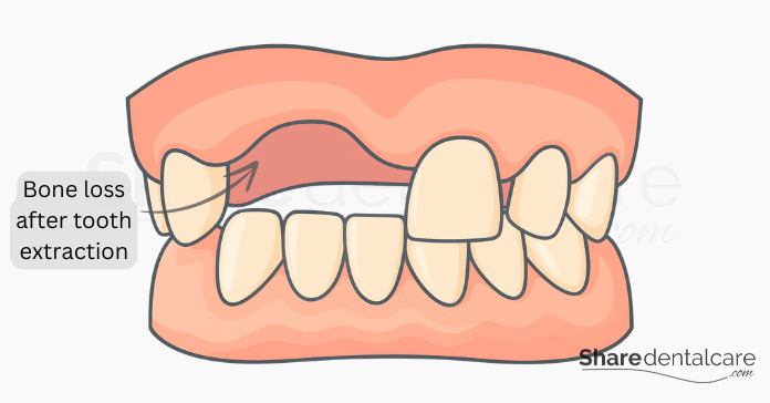 Bone Graft after Tooth Extraction: Why It’s Needed and Recovery - Share Dental Care