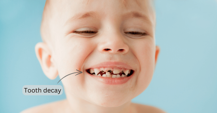 Early Childhood Caries: Understanding ECC and Its Risk Factors - Share ...