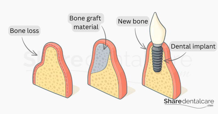 Dental Bone Graft Healing Stages: Timeline for Bone Recovery - Share ...