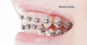 Open Bite: What Causes This Malocclusion and How to Fix It? - Share ...