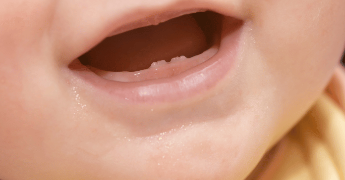 Baby Born with Teeth: What Are Natal Teeth and What to Do? - Share ...