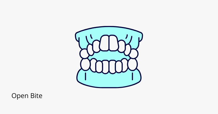 Open Bite: What Causes This Malocclusion and How to Fix It? - Share ...