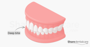 Deep Bite: Exploring What Causes a Deep Bite and How to Treat It ...