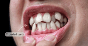 Crowded Teeth: Causes of Dental Crowding & Orthodontic Options - Share ...