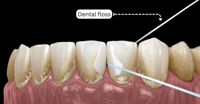 How to Remove Tartar from Teeth Without Dentist? - Share Dental Care
