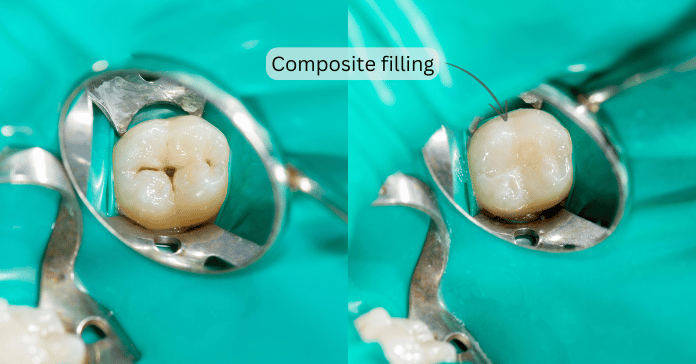 How Long Does a Cavity Filling Last? Lifespan and Care Tips - Share ...