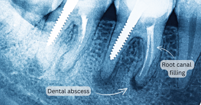 Root Canal Failure: Signs of a Failed Root Canal and How to Fix It ...