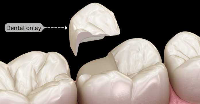 Dental Onlay: A Complete Guide to Restoring Damaged Teeth - Share ...