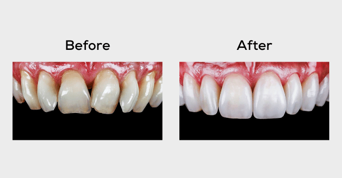 Composite Resin Veneers: Benefits and Procedure Explained - Share ...