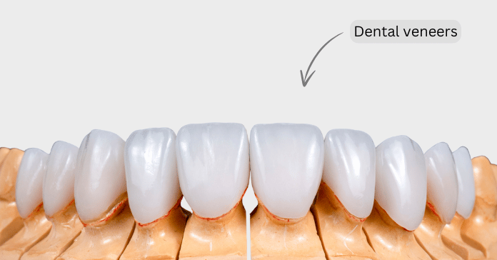 Composite Resin Veneers: Benefits and Procedure Explained - Share ...